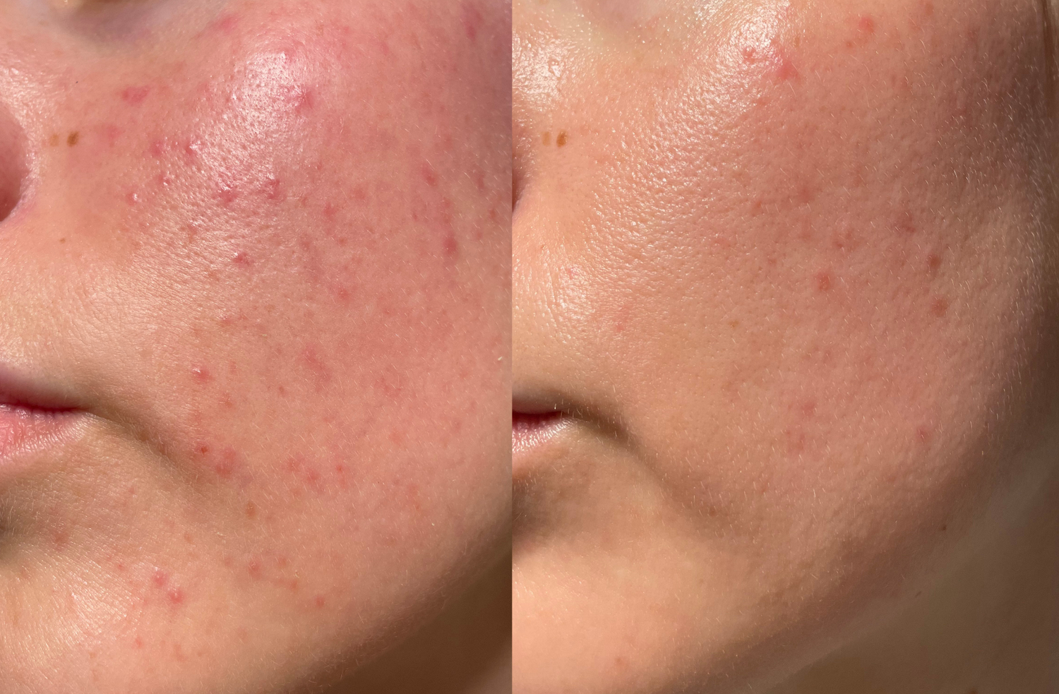How Do You Treat & Clear Up Rosacea Pustules and Papules? | Foundation ...