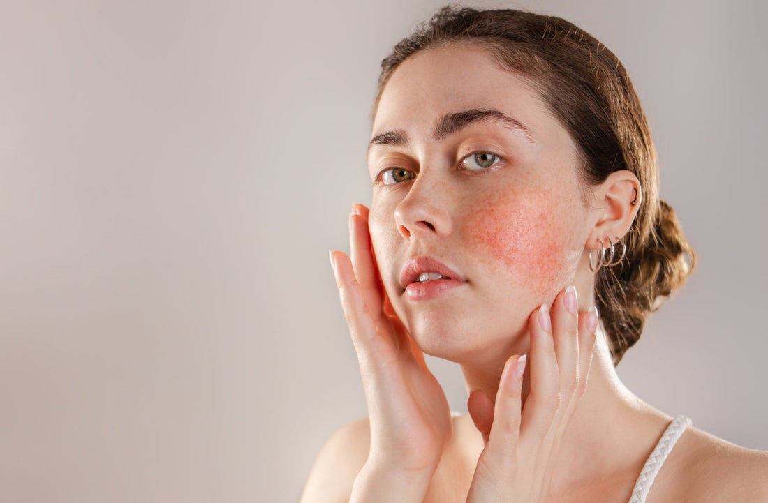 How to Treat Rosacea Papules and Pustules Effectively | Foundation Skincare